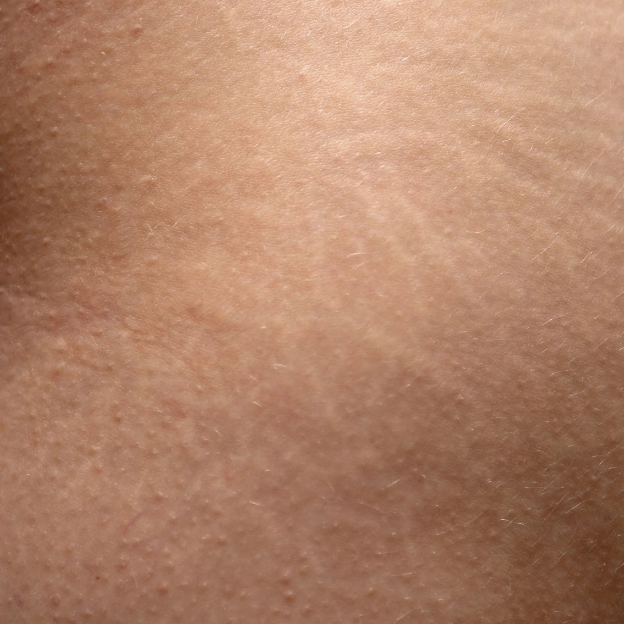 Microneedling Before and After: Stretch Marks